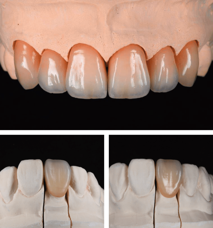 【モリタ】[WEBINAR] Relearn PFZ with Webinar - Porcelain Fixed Zirconia 歯科情報 ...